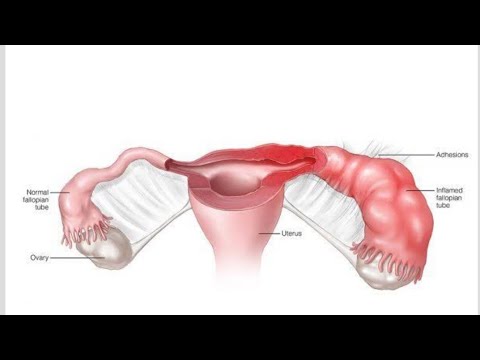 Tubo Ovarian Abscess ; Definition, Causes, Symptoms, Diagnosis, Treatment and Complications