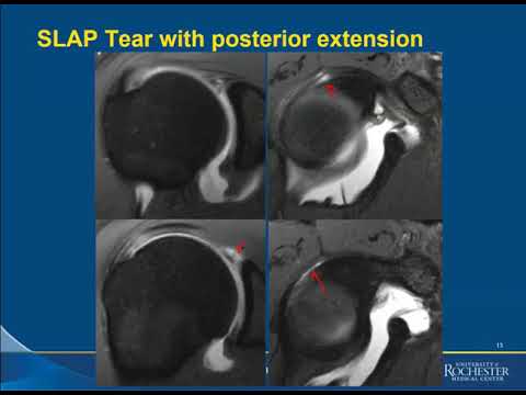 MRI Shoulder Arthrography Interpretation and Variants