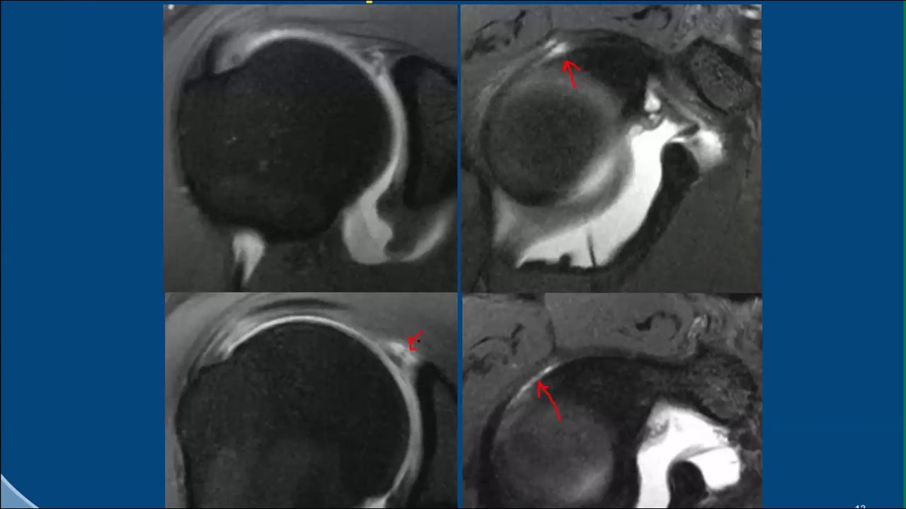 MRI Shoulder Arthrography Interpretation and Variants