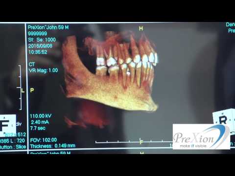 Prexion's Excelsior CBCT Unit: Interview with Dr. Jon Julian