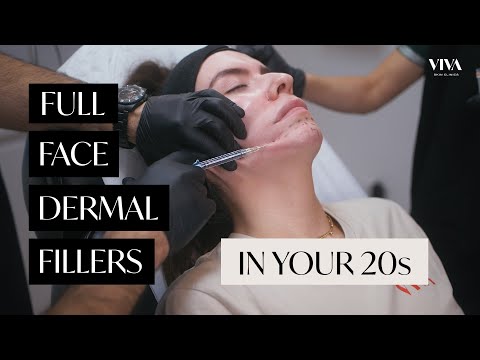 Full Face Dermal Fillers | Chin and Cheek Filler Tutorial with 11mls of filler |2022