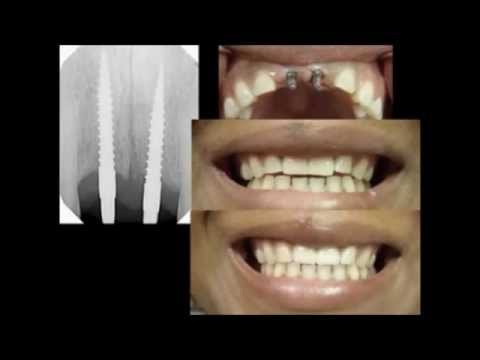 Mini Dental Implants - Immediate Tooth Replacement - Dr. Peter Mann DDS, FICOI, FAGD