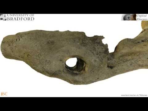 Ballistic trauma | Digitised Diseases