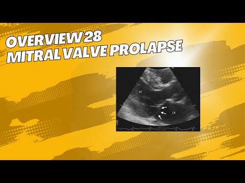 Overview 28 : Mitral Valve Prolapse
