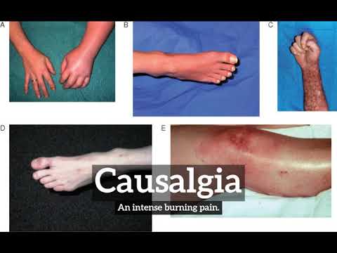 What is Causalgia? | How to Say Causalgia in English? | How Does Causalgia Look?