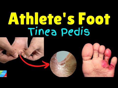 Athlete's Foot (Tinea pedis): Symptoms, Causes & Treatment - Foot Fungus