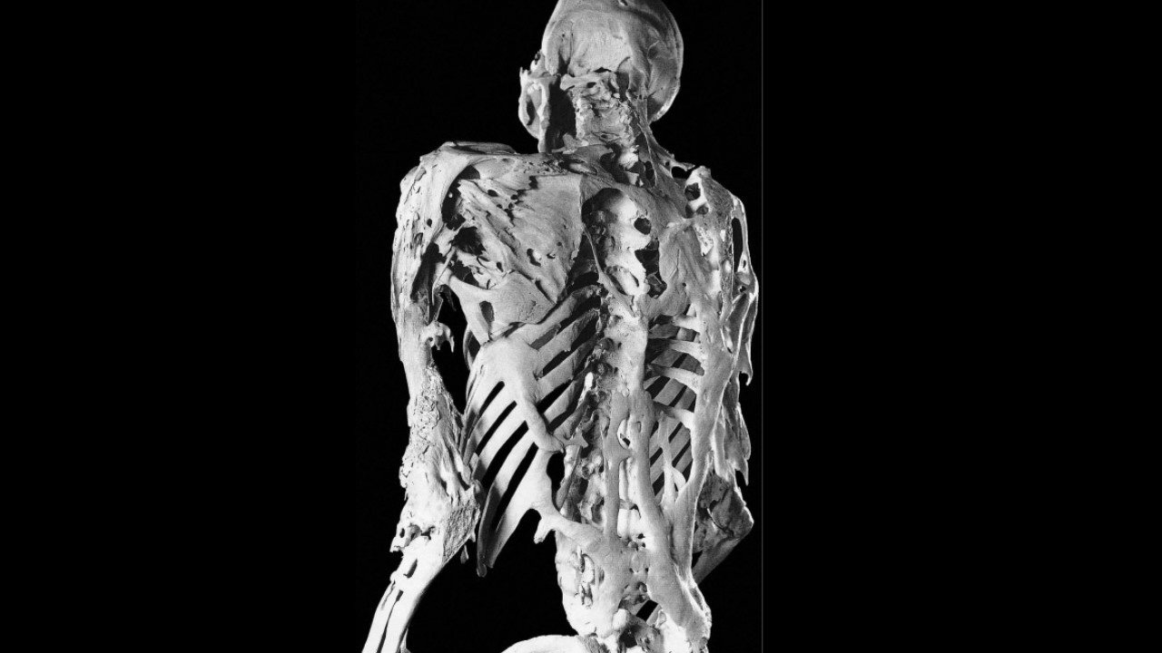 A second skeleton forms inside this child - Stone Man Syndrome