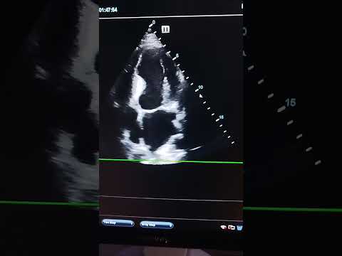 scarred Apex ( Ischemic Dilated Cardiomyopathy)