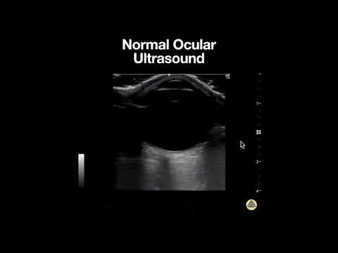 Normal Ocular Ultrasound Anatomy