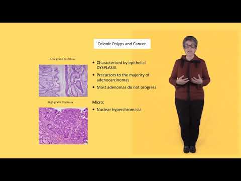 Colonic polyps and cancer