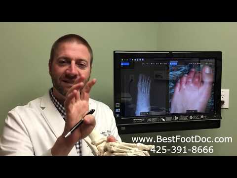 Hammer Toe -- Treatments and Information