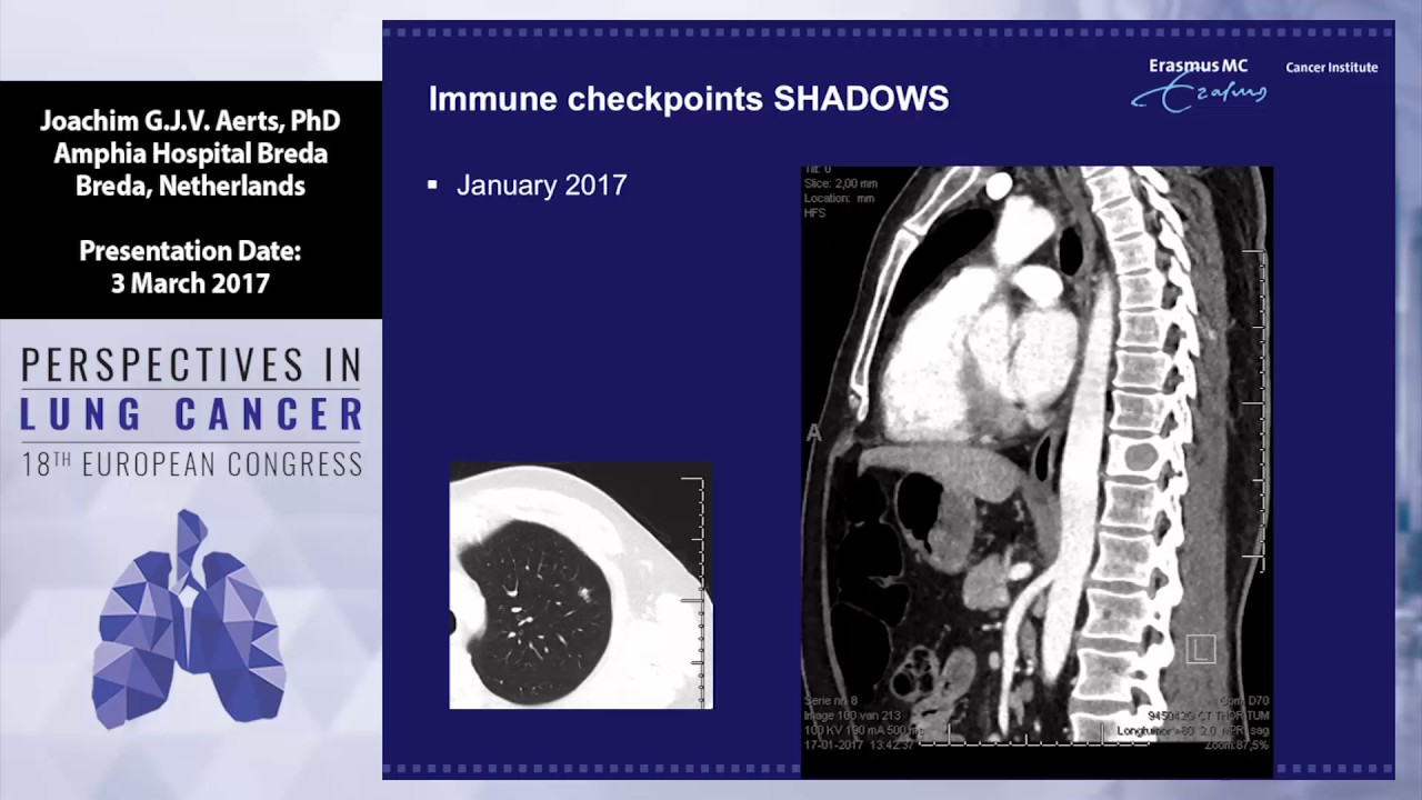 Immune checkpoint inhibitors in lung cancer: Lights and shadows