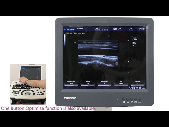Ultrasound Machine - Zoncare Q7 Ultrasound Machine Service Provider ...