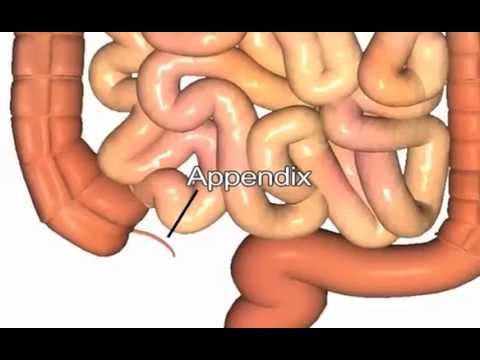 Appendectomy Surgery for Appendicitis (removal of appendix)