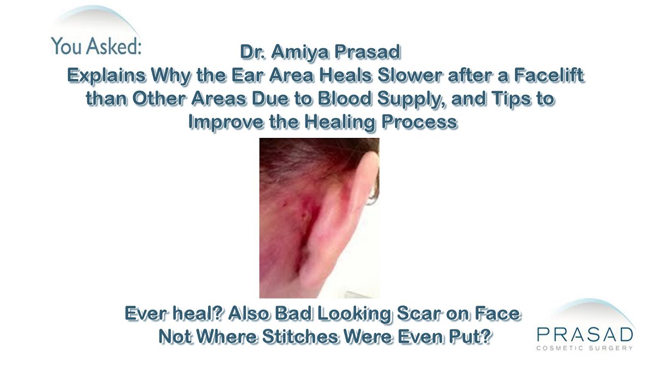 Why the Ears Heal Slowly after a Facelift and How to Improve Healing in this Area