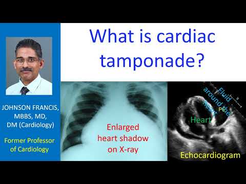 What is cardiac tamponade?