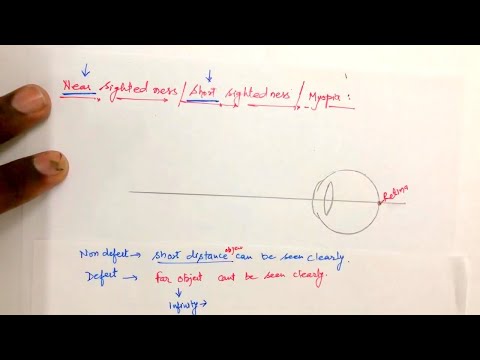 myopia\nearsightedness\short sightedness\myopia causes\short sighted\near sightedness\what is myopia