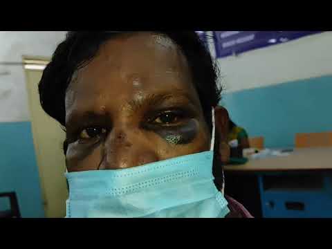 Raccoon eyes / black eyes /pandas sign in base of skull fracture