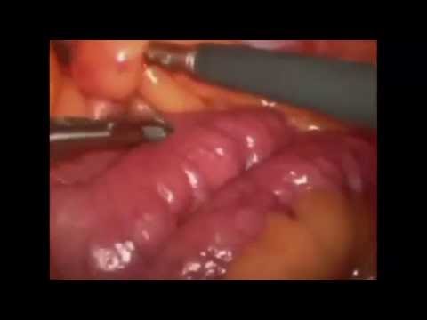 Laparoscopic Roux-en-Y Gastric Bypass Surgical Technique
