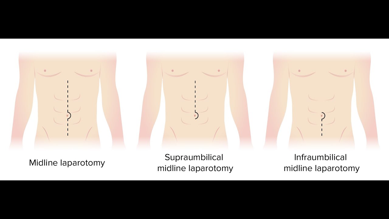 Exploratory Laparotomy CPT code - simplify medical coding