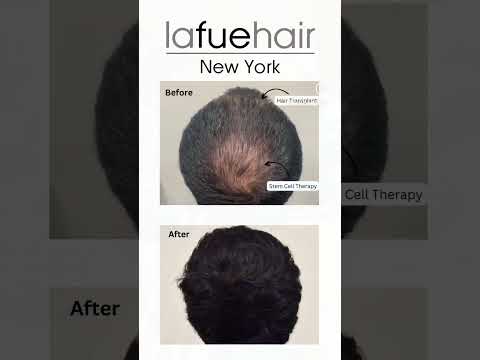 Stem Cell Therapy for Hair