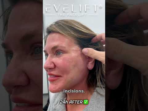 Patient Testimonial 24 Hours After EVE Lift™ With Dr. Charafeddine | Eden Plastic Surgery