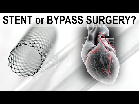 Stent or Bypass Surgery?