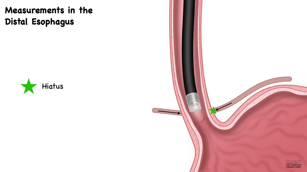HCC 1475.1-Esophagus-Anatomy