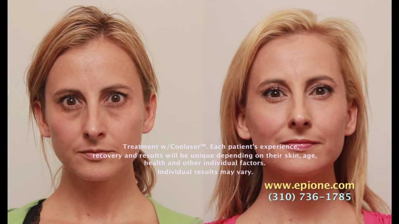 Dark Circles Treatment