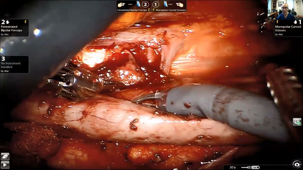 Minimally-Invasive RPLND: Equivalent to Open Surgery for Germ Cell Tumors?