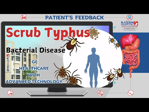 ππππ’ππ§π π
πππππππ€ | Mr. Khubilal Paliwal | Kaizen Hospital | Scrub Typhus - Infectious GI Diseases