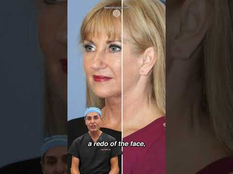 Secondary Lower Face & Necklift Case Study by Dr. Kevin Sadati #facelift #necklift #shorts
