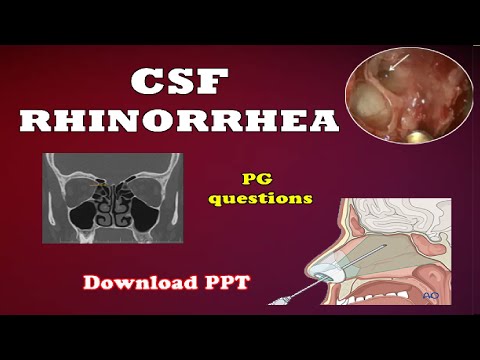 CSF RHINORRHEA | ENT | Easy explanation - All you need to know