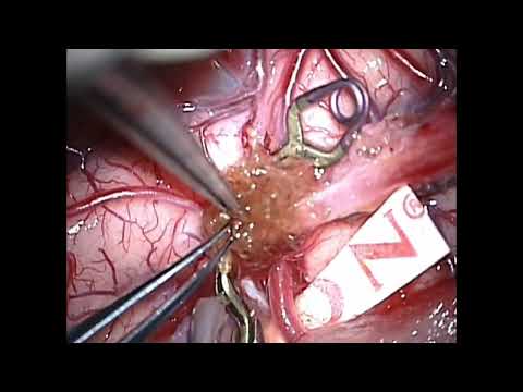 Cavernous ICA aneurysm: EC IC bypass and ICA ligation