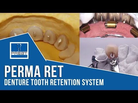 PERMA RET Denture Tooth Retention System By PREAT Corporation