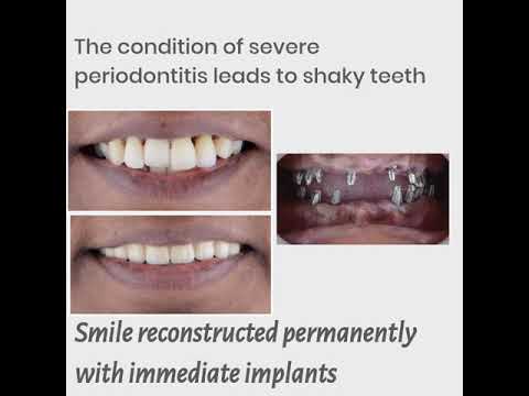 Immediate Implants| Full mouth Rehabilitation| We Dental| Smile Reconstruction| New smile| Dr Arshad