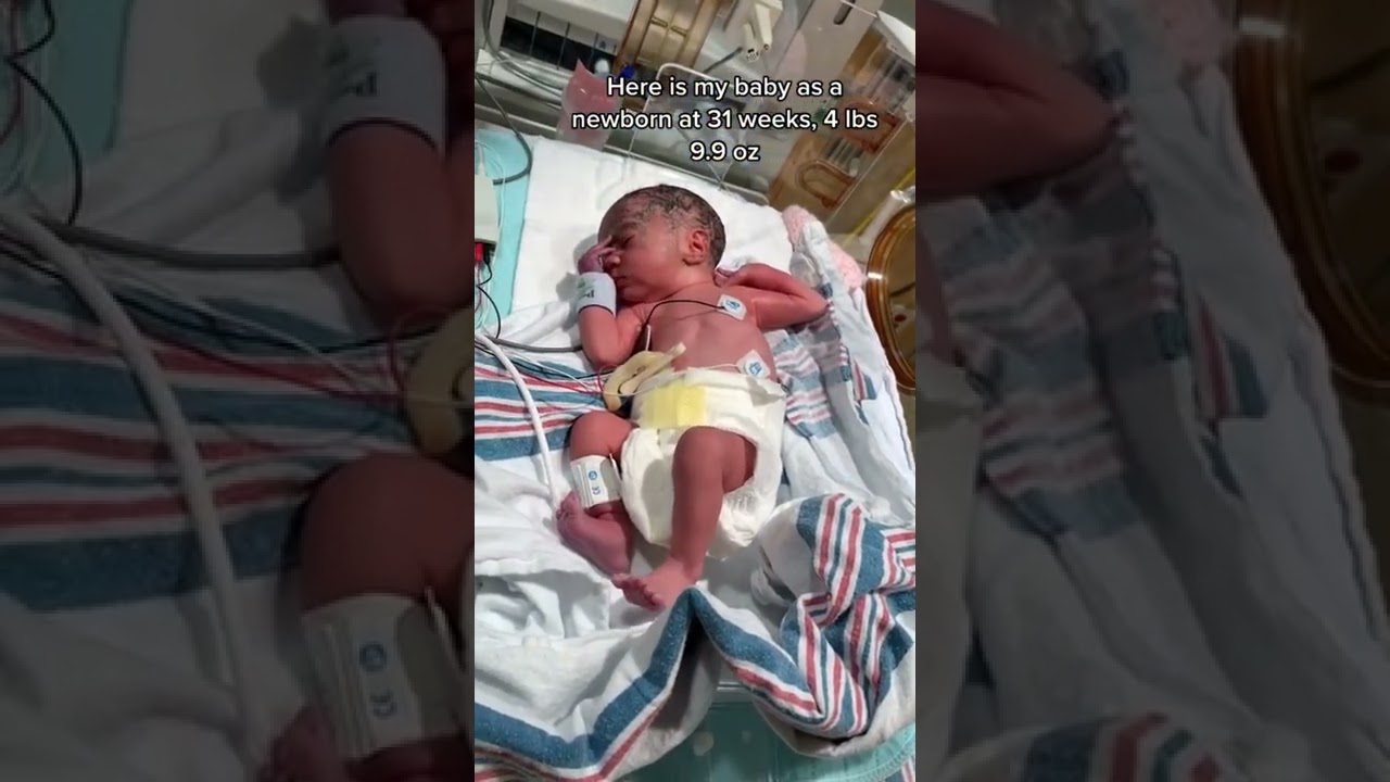 Our miracle baby girl! Born at 31weeks #nicubaby #gtube #shorts
