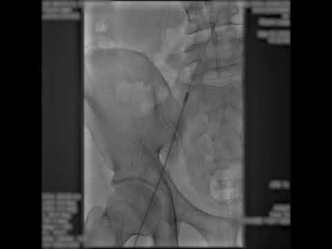 Complication of IVC Filter: A Forgotten Inferior Vena Cava (IVC) Filter ...