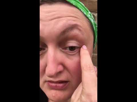 Rita's BOTOX® Cosmetic Journey: Day 3 | Ann Arbor's Center for Plastic & Reconstructive Surgery
