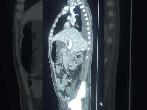Abdomen CT with contrast, sagittal plane