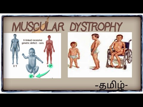 Muscular dystrophy #Tamil #தமிழ் #Muscular dystrophy @meditamil