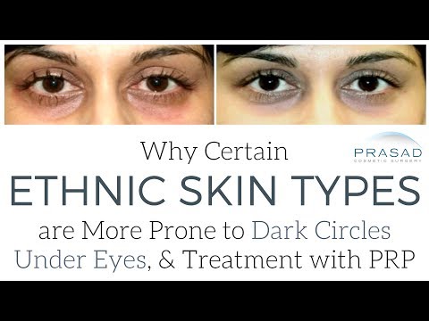 How Certain Ethnic Skin Types are More Prone to Under Eye Dark Circles, and How to Treat Them