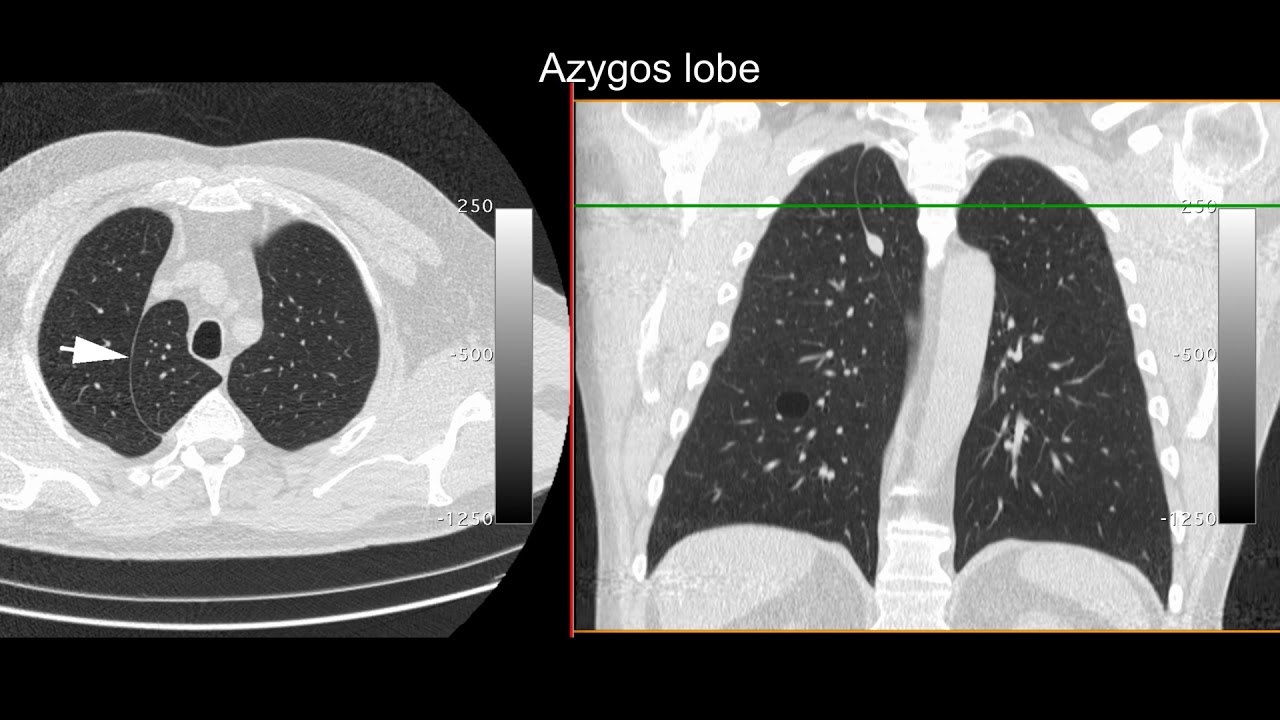 Essential normal variants the chest radiologist doesn't want you to know
