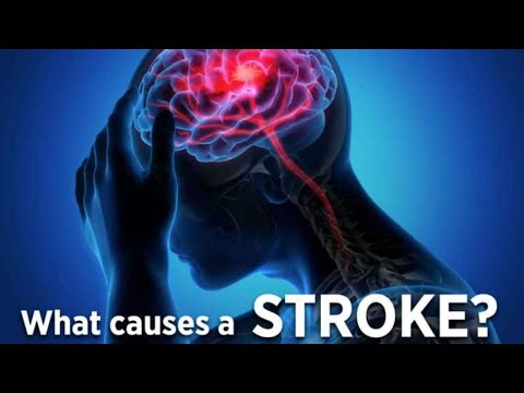 What causes a stroke? A stroke can cause severe damage or death