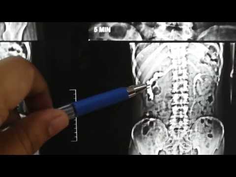right kidney Para pelvic cyst