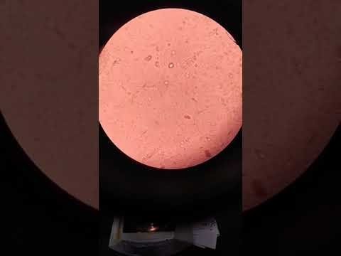 urine hyaline cast in