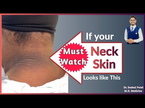 Acanthosis Nigricans l Dr. Snehal Patel l Hindi