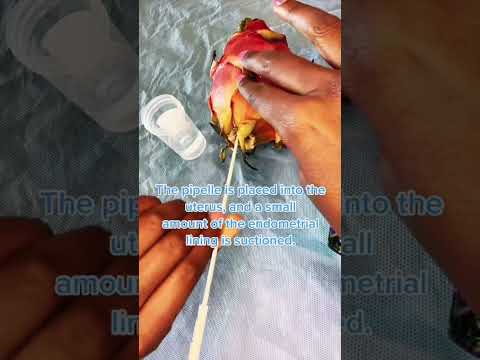 What is an Endometrial Biopsy?