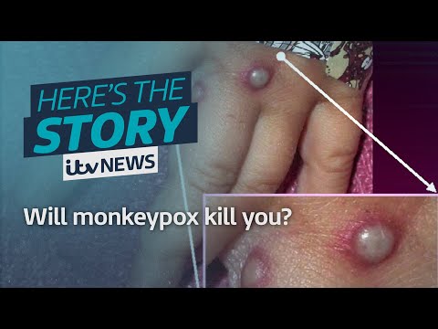 Will monkeypox kill you? | ITV News