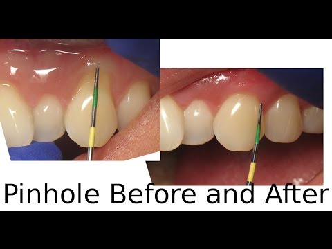 Long in the tooth treatment Gum Rejuvenation Gum Graft Alternative Dentist in Los Angeles Downey Ca